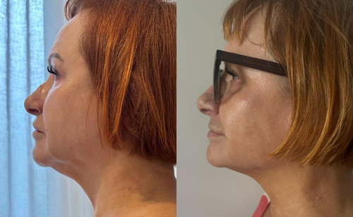 UltraClear Laser Coring: Skin Tightening & Rejuvenation - Sydney's ...